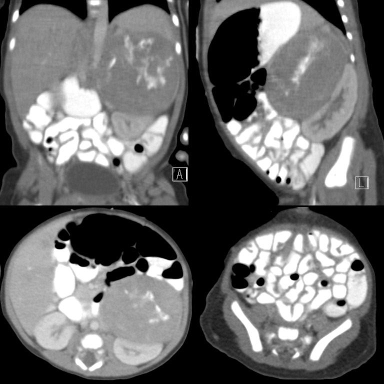 Newborn with a left abdominal mass and palpable subcutaneous nodules on ...