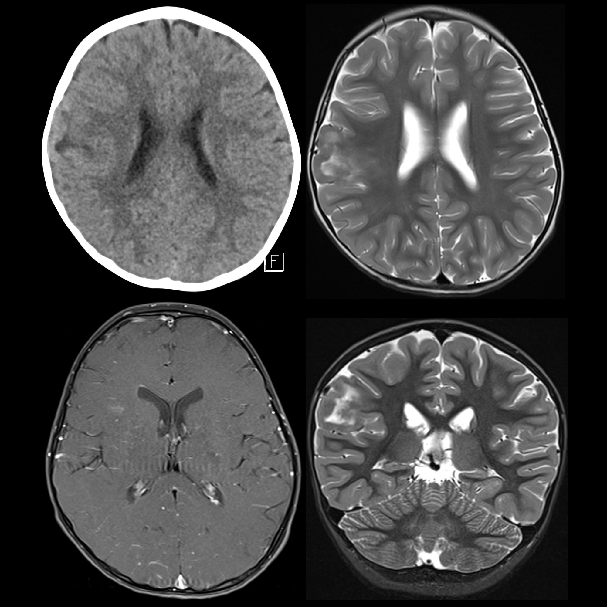 Preschooler with seizures | Pediatric Radiology Case | Pediatric ...