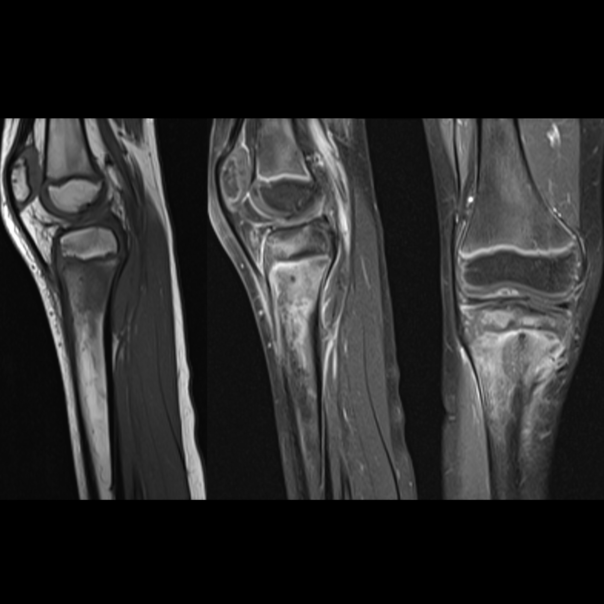 School ager with knee pain for several months | Pediatric Radiology ...