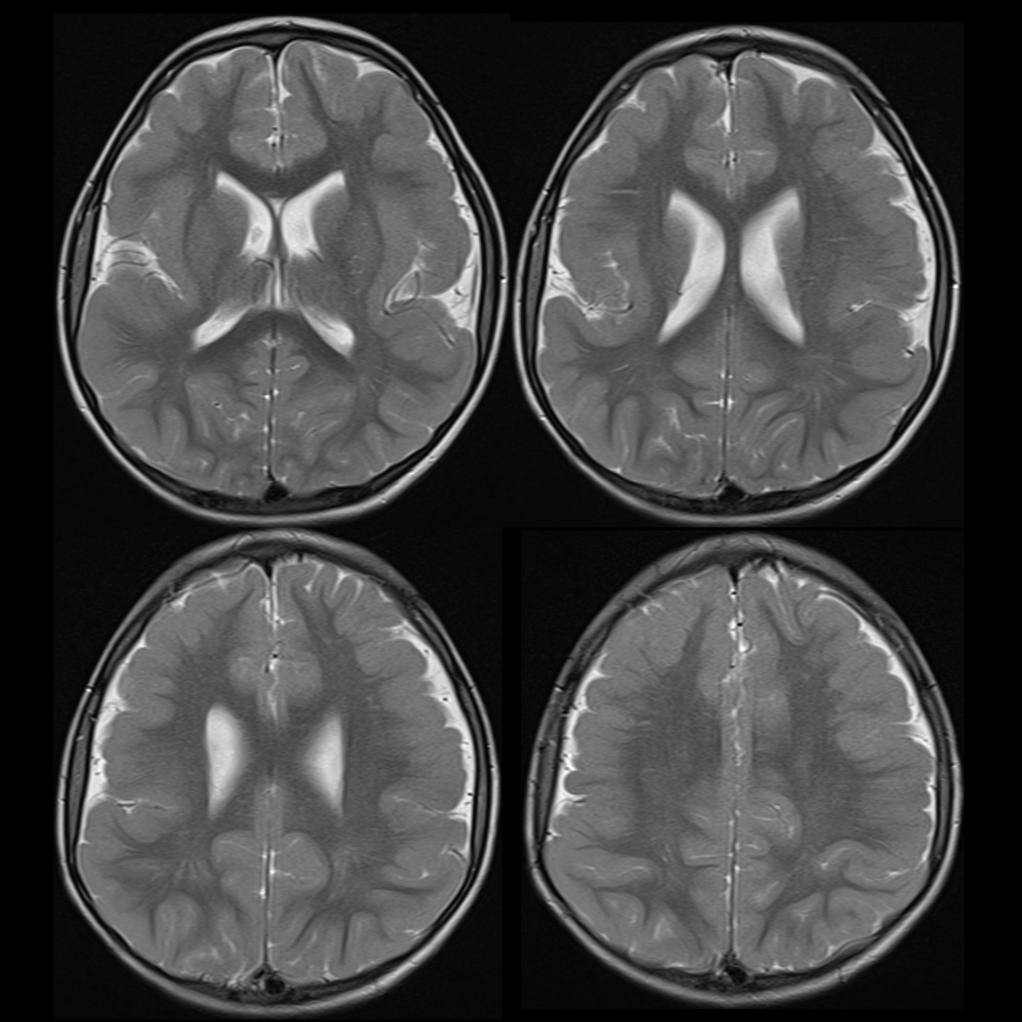 Polymicrogyria | Pediatric Radiology Reference Article | Pediatric ...