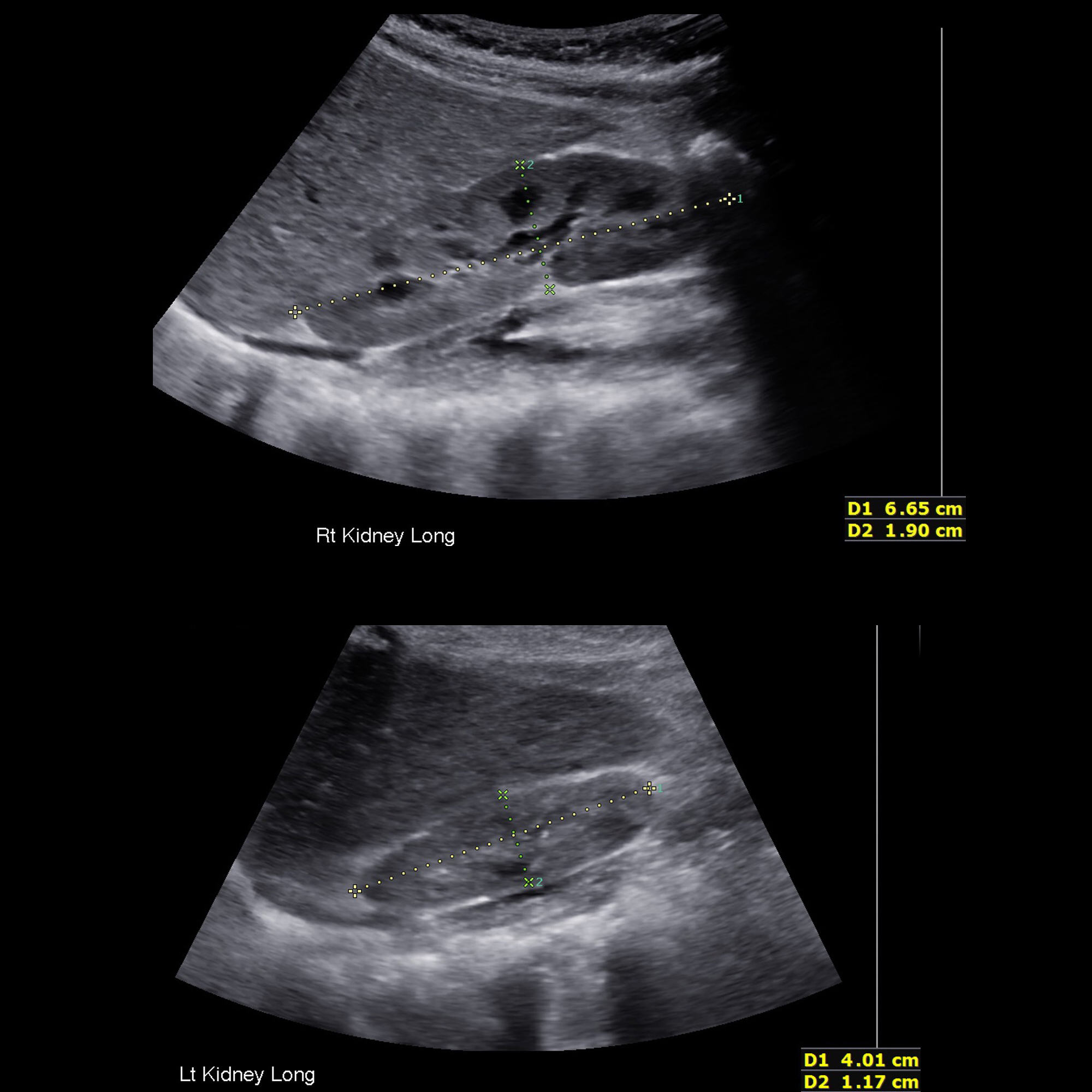 Pediatric Renal Vein Thrombosis | Pediatric Radiology Reference Article ...