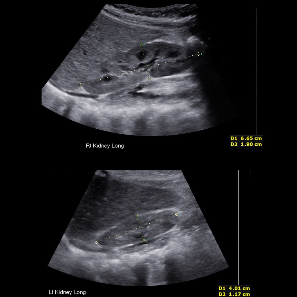 Pediatric Renal Vein Thrombosis | Pediatric Radiology Reference Article ...