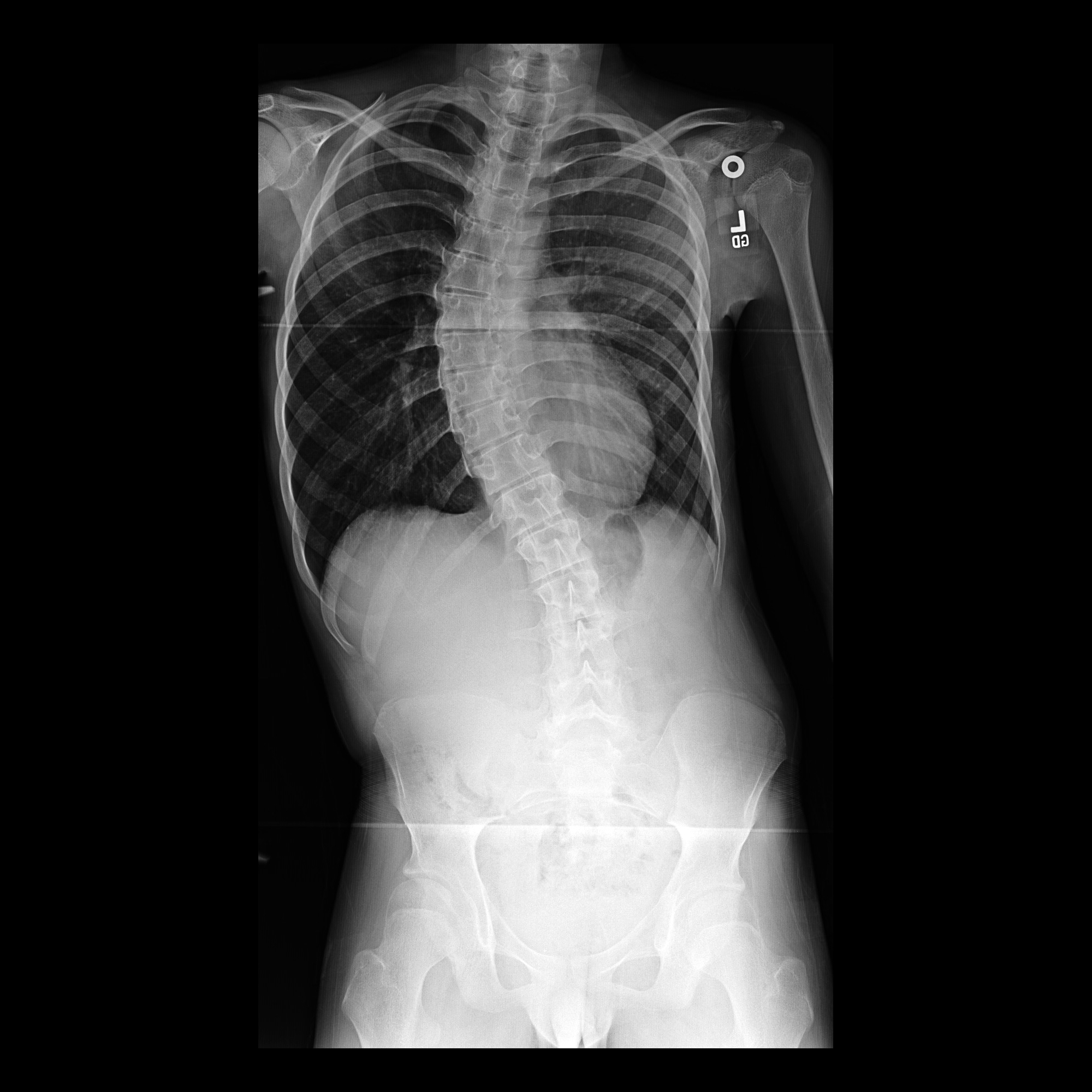 Neuromuscular Scoliosis | Pediatric Radiology Reference Article ...