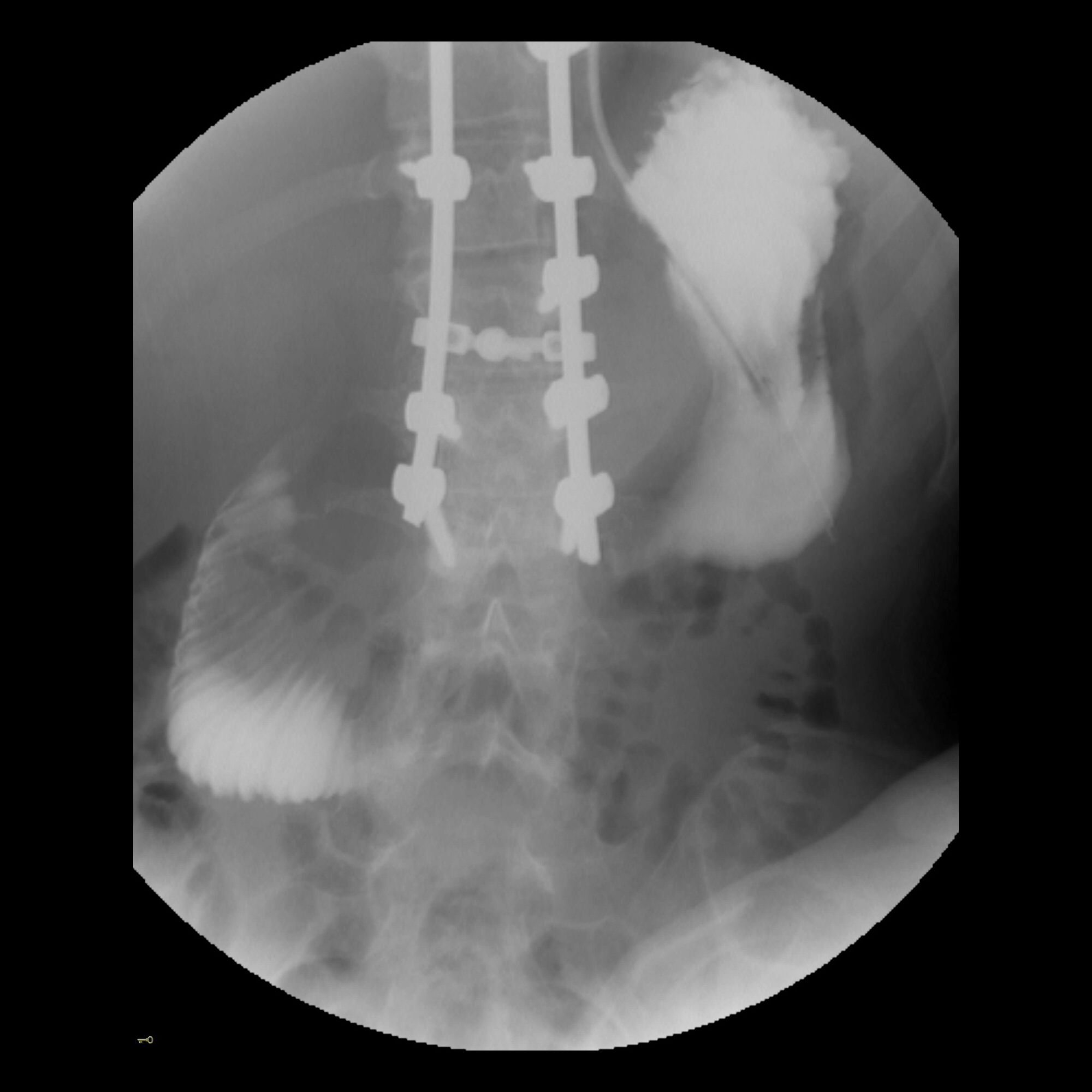 Teenager with vomiting after posterior spinal fusion 1 week ago ...