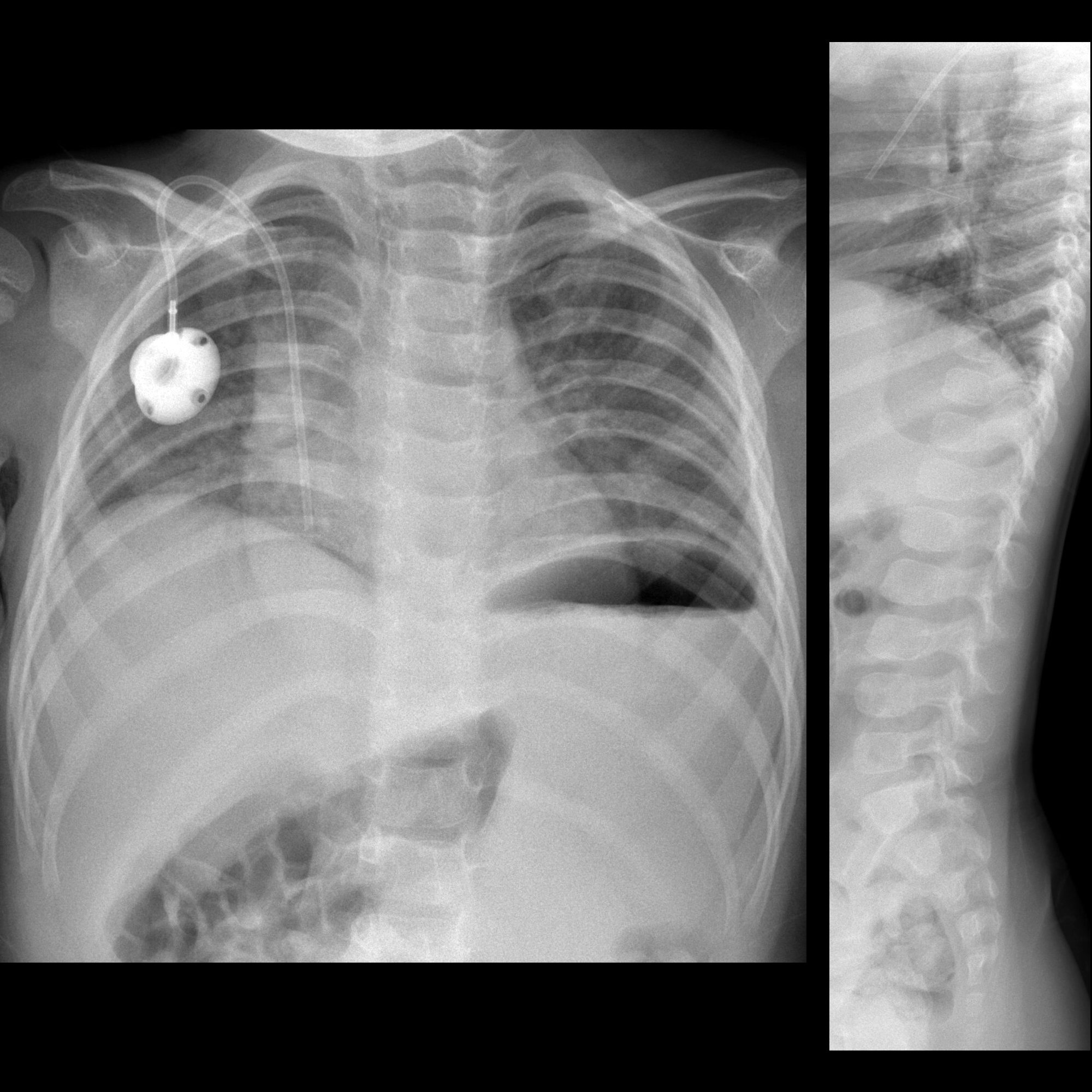 Radiologia Da Sindrome De Hurler