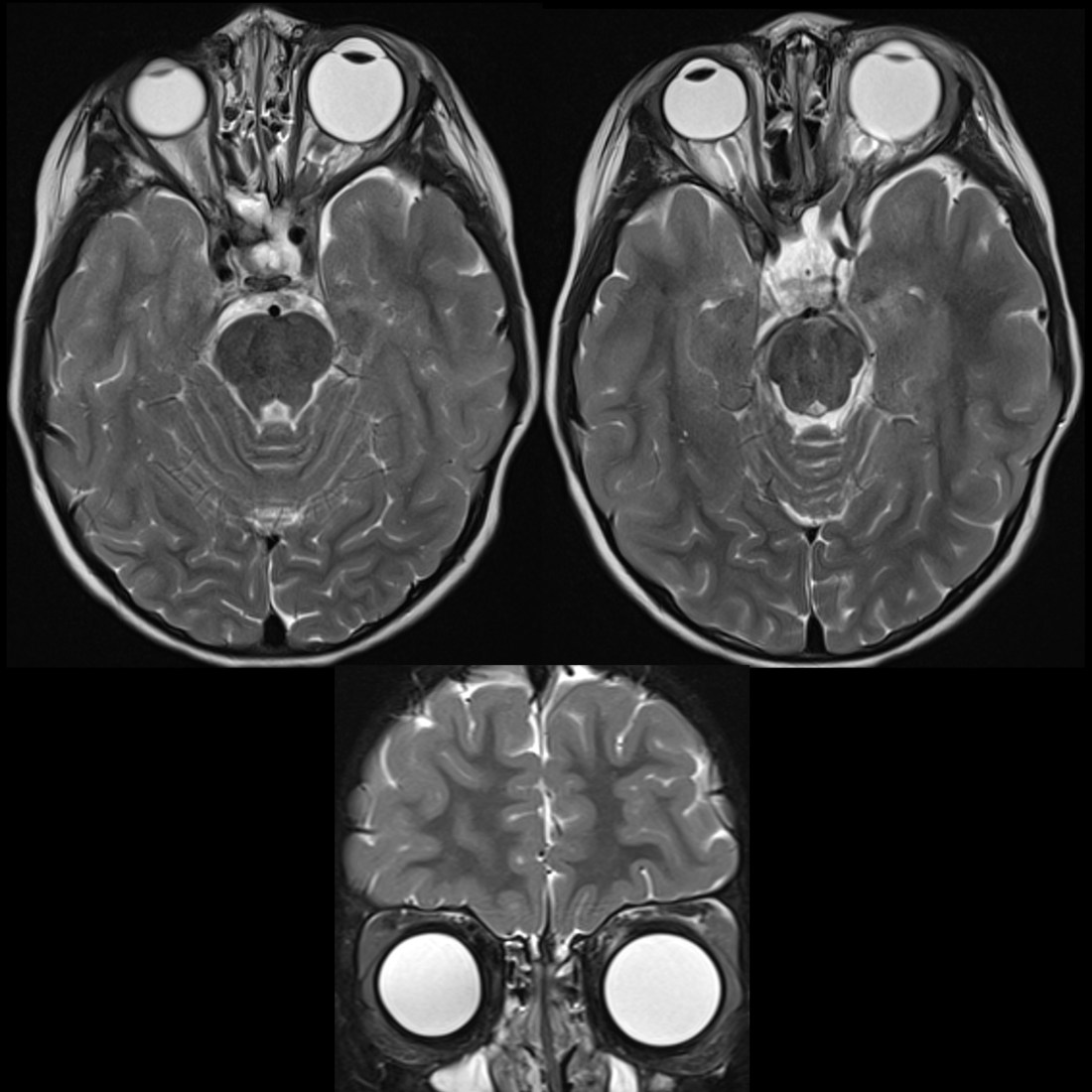 Preschooler with difficulties with vision | Pediatric Radiology Case ...