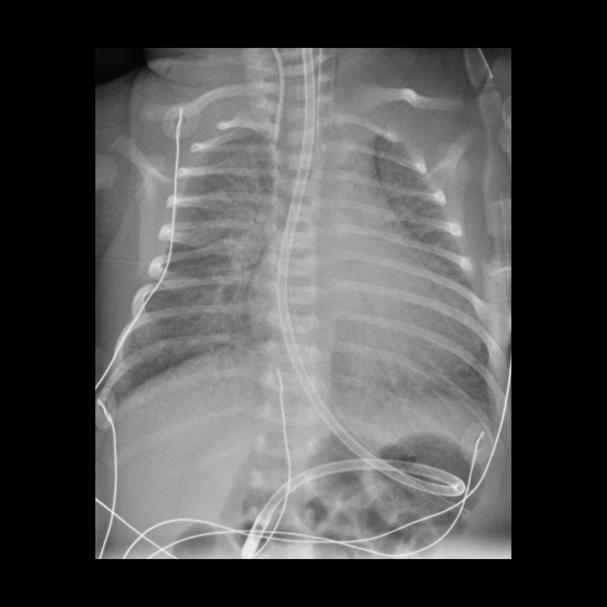 Pediatric Myocarditis | Pediatric Radiology Reference Article ...