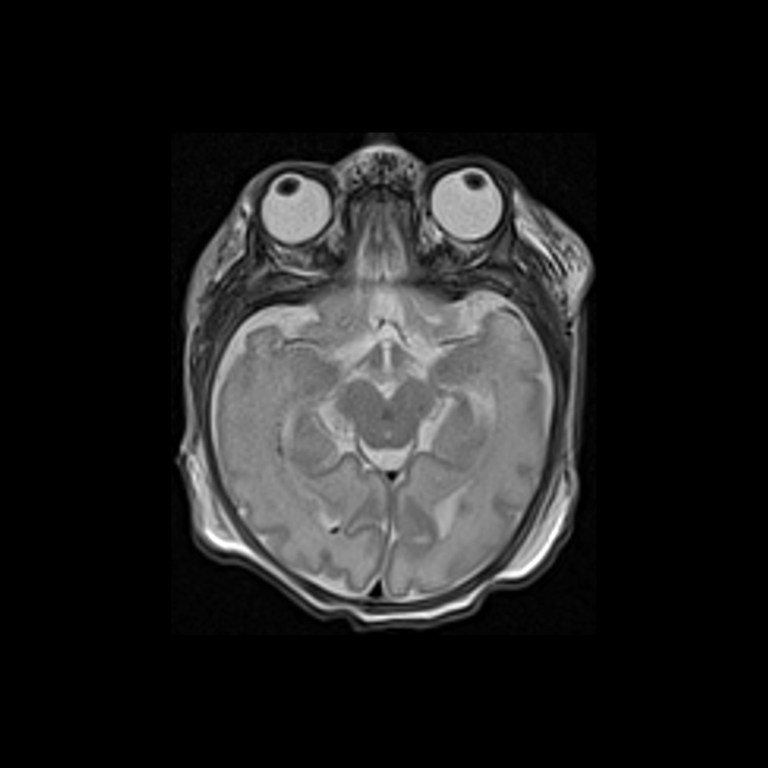 Pediatric Microphthalmia | Pediatric Radiology Reference Article ...