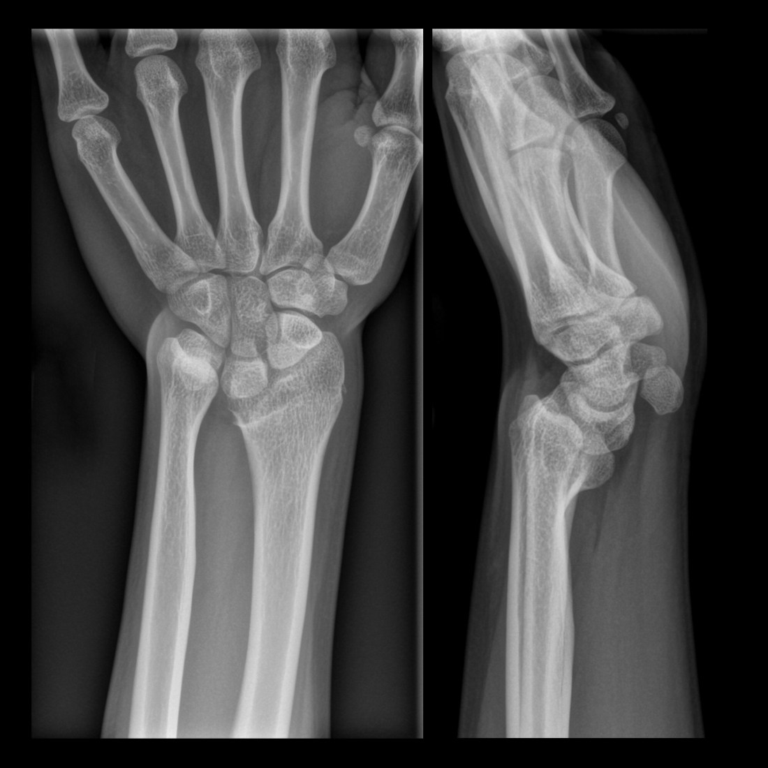 Madelung Deformity | Pediatric Radiology Reference Article | Pediatric ...