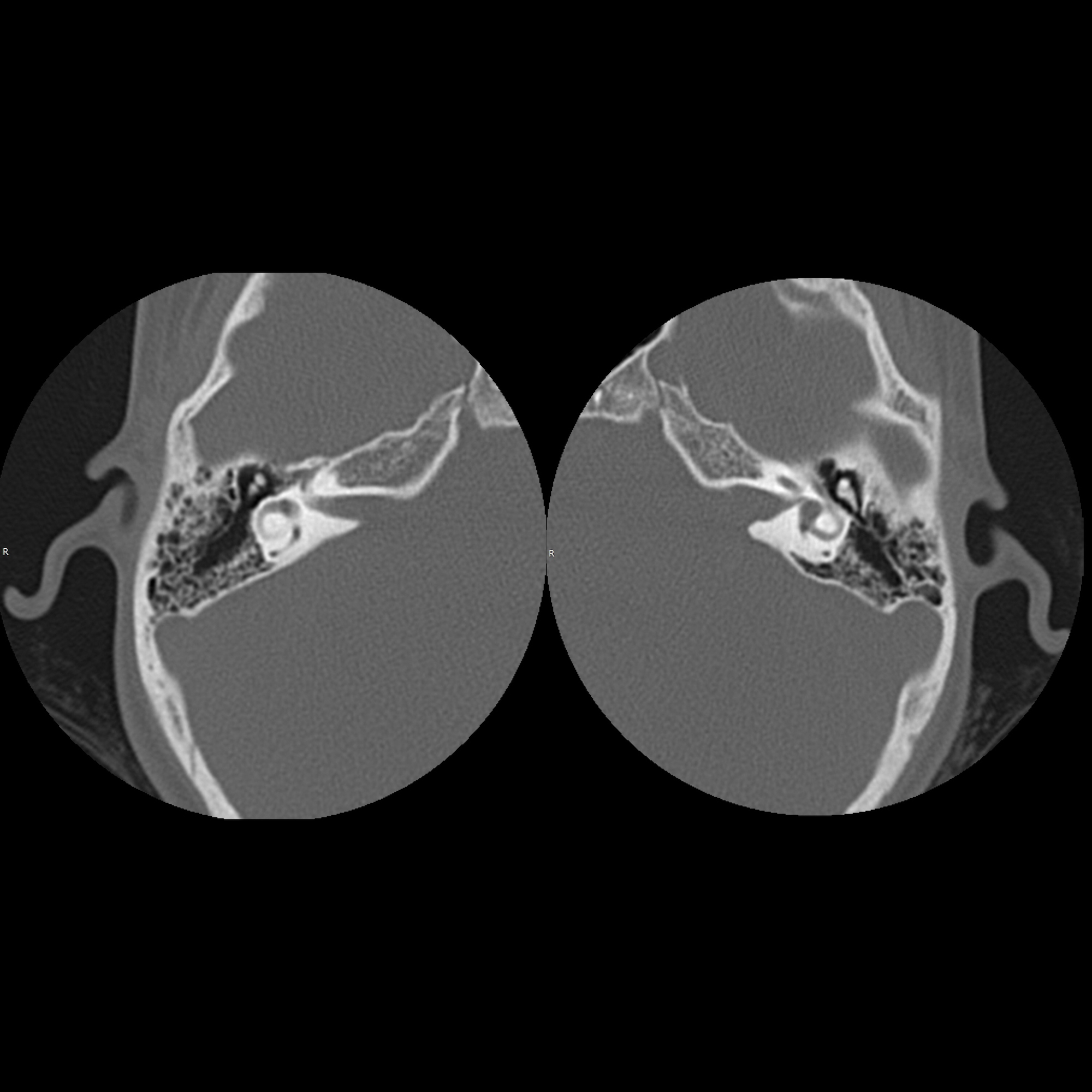 Pediatric Acoustic Neuroma | Pediatric Radiology Reference Article ...