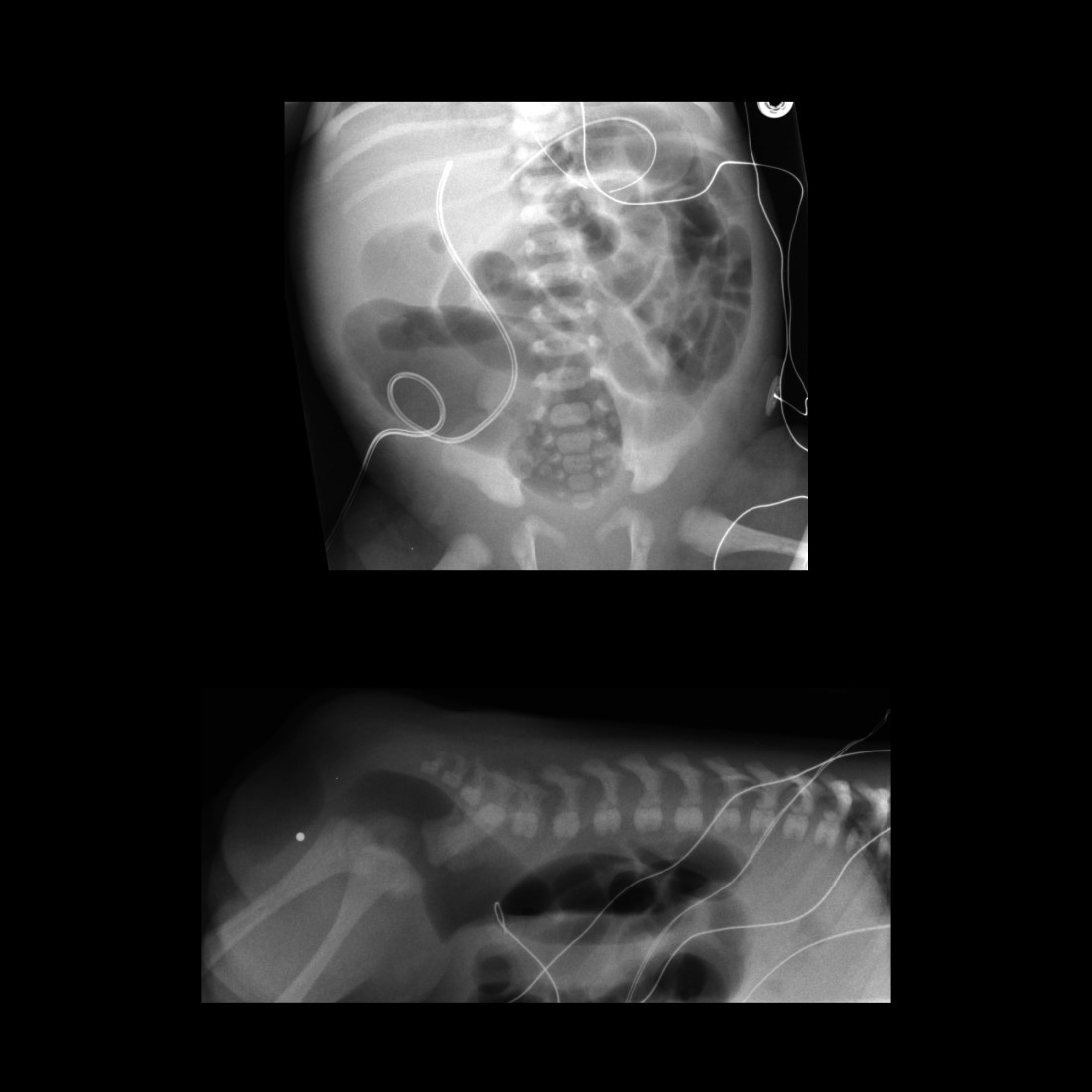 Anorectal Malformation | Pediatric Radiology Reference Article ...