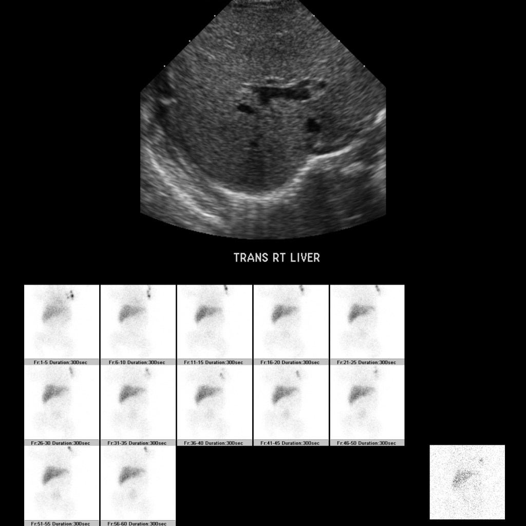 Biliary Atresia | Pediatric Radiology Reference Article | Pediatric ...