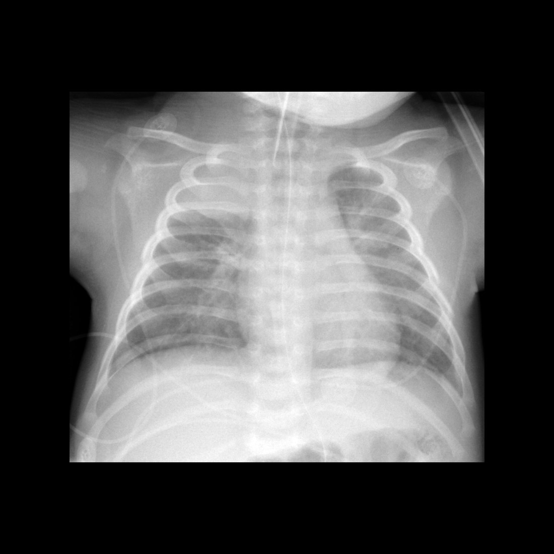 Pediatric Rib Fracture | Pediatric Radiology Reference Article ...