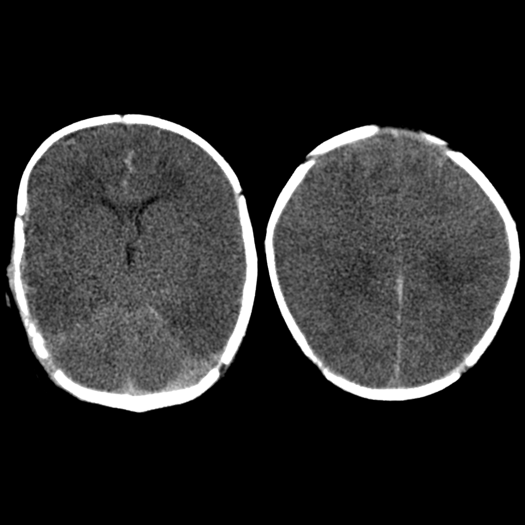 ChildAbuse12MDPostCPRAcuteLeft5th ...