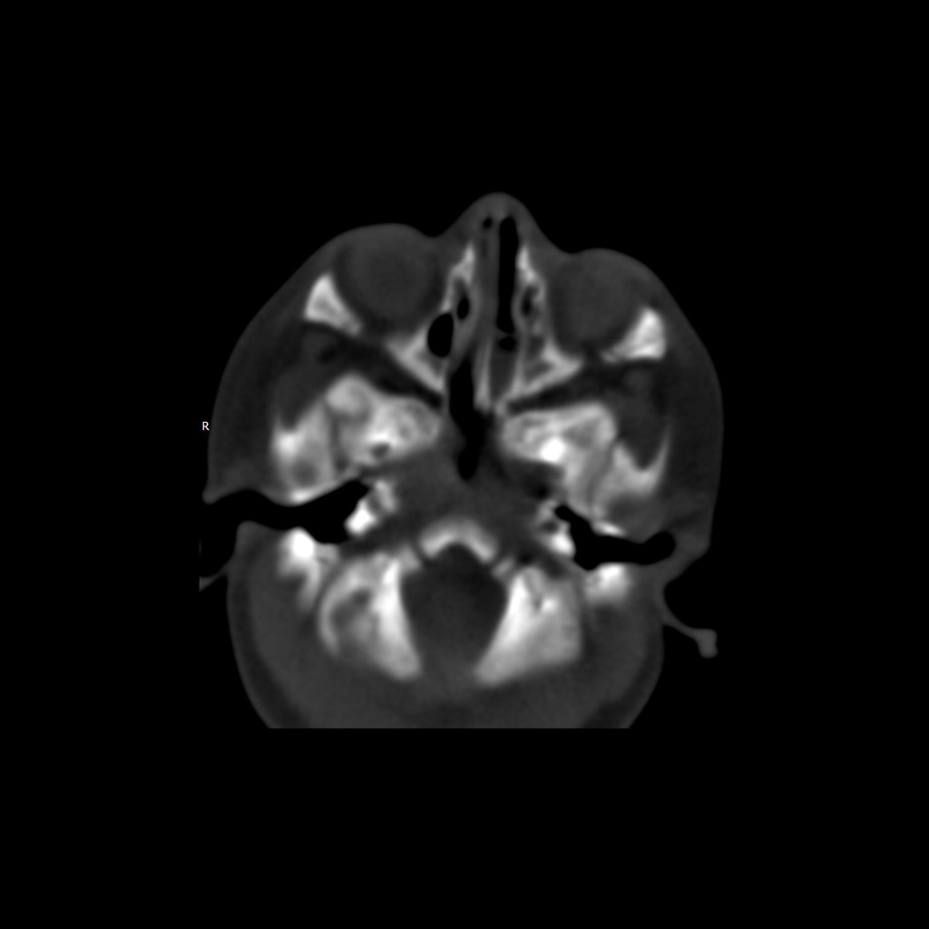 Choanal Atresia | Pediatric Radiology Reference Article | Pediatric ...