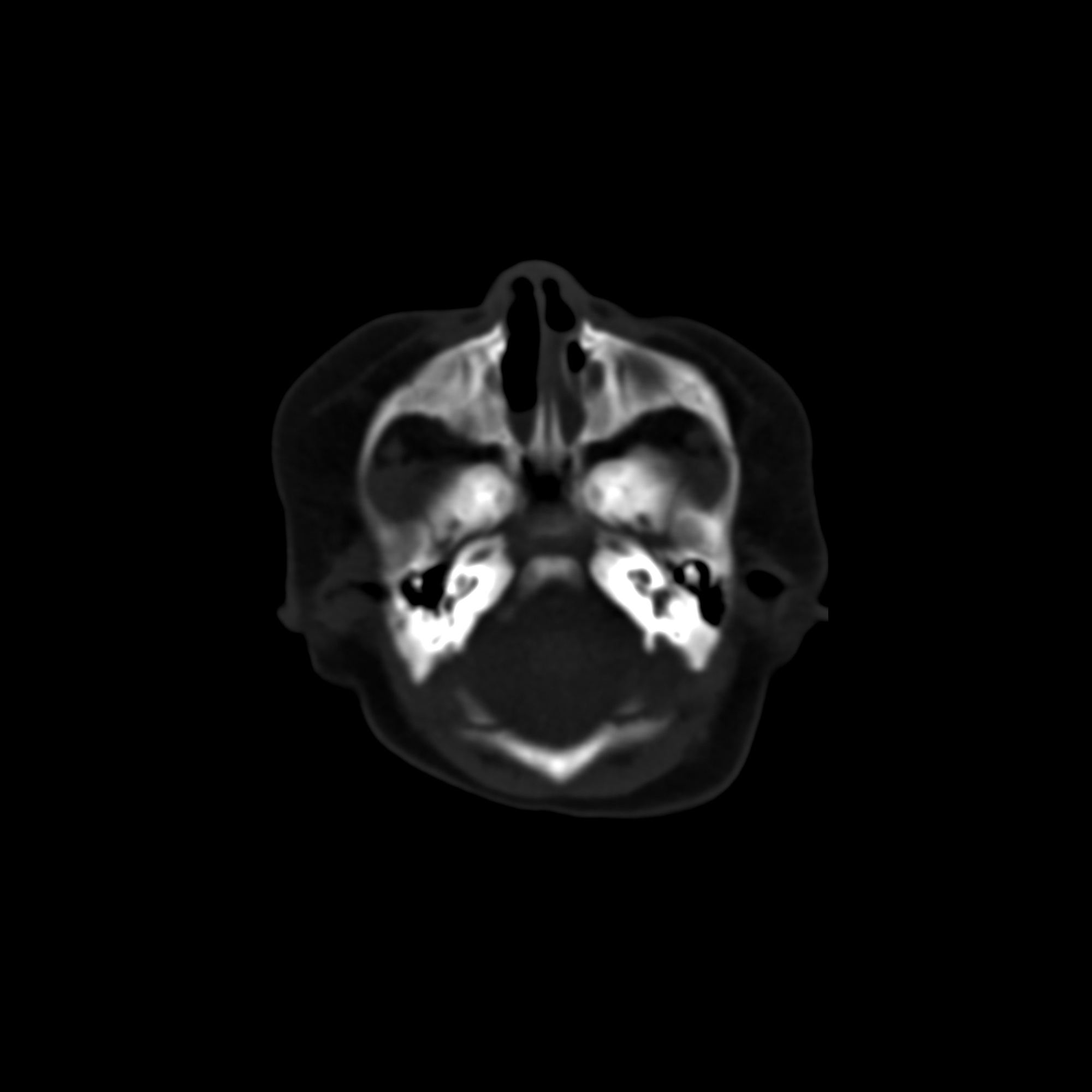 Choanal Atresia | Pediatric Radiology Reference Article | Pediatric ...