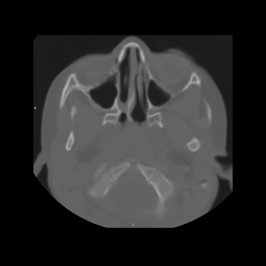 Choanal Atresia | Pediatric Radiology Reference Article | Pediatric ...
