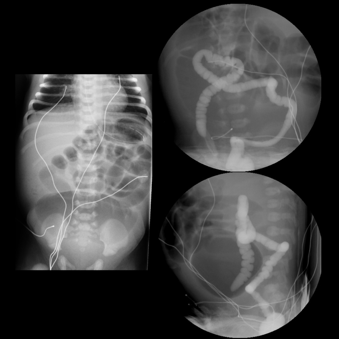 Colonic Atresia | Pediatric Radiology Reference Article | Pediatric ...