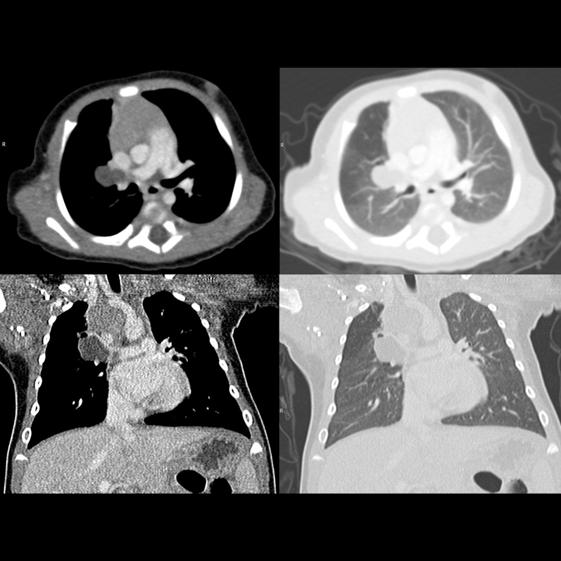 Congenital Pulmonary Airway Malformation | Pediatric Radiology ...