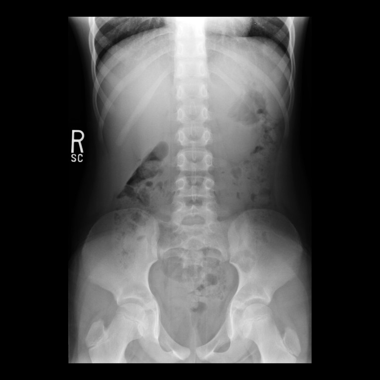 Pediatric Constipation | Pediatric Radiology Reference Article ...