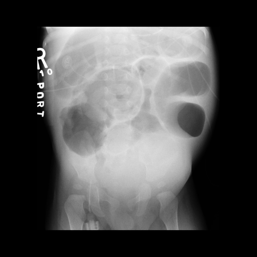 Pediatric Constipation | Pediatric Radiology Reference Article ...