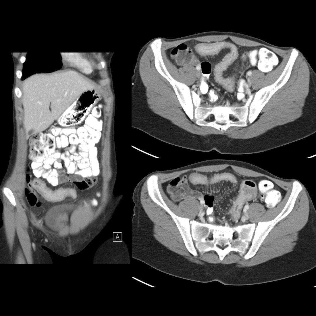 Teenager with chronic right lower quadrant pain | Pediatric Radiology ...