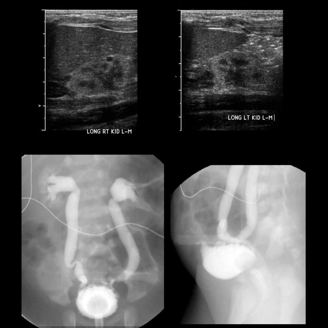 Pediatric Vesicoureteral Reflux | Pediatric Radiology Reference Article ...