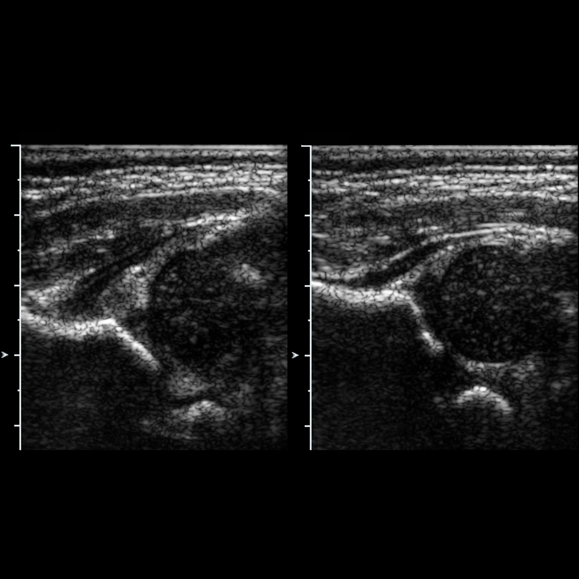 Developmental Dysplasia of the Hip | Pediatric Radiology Reference ...