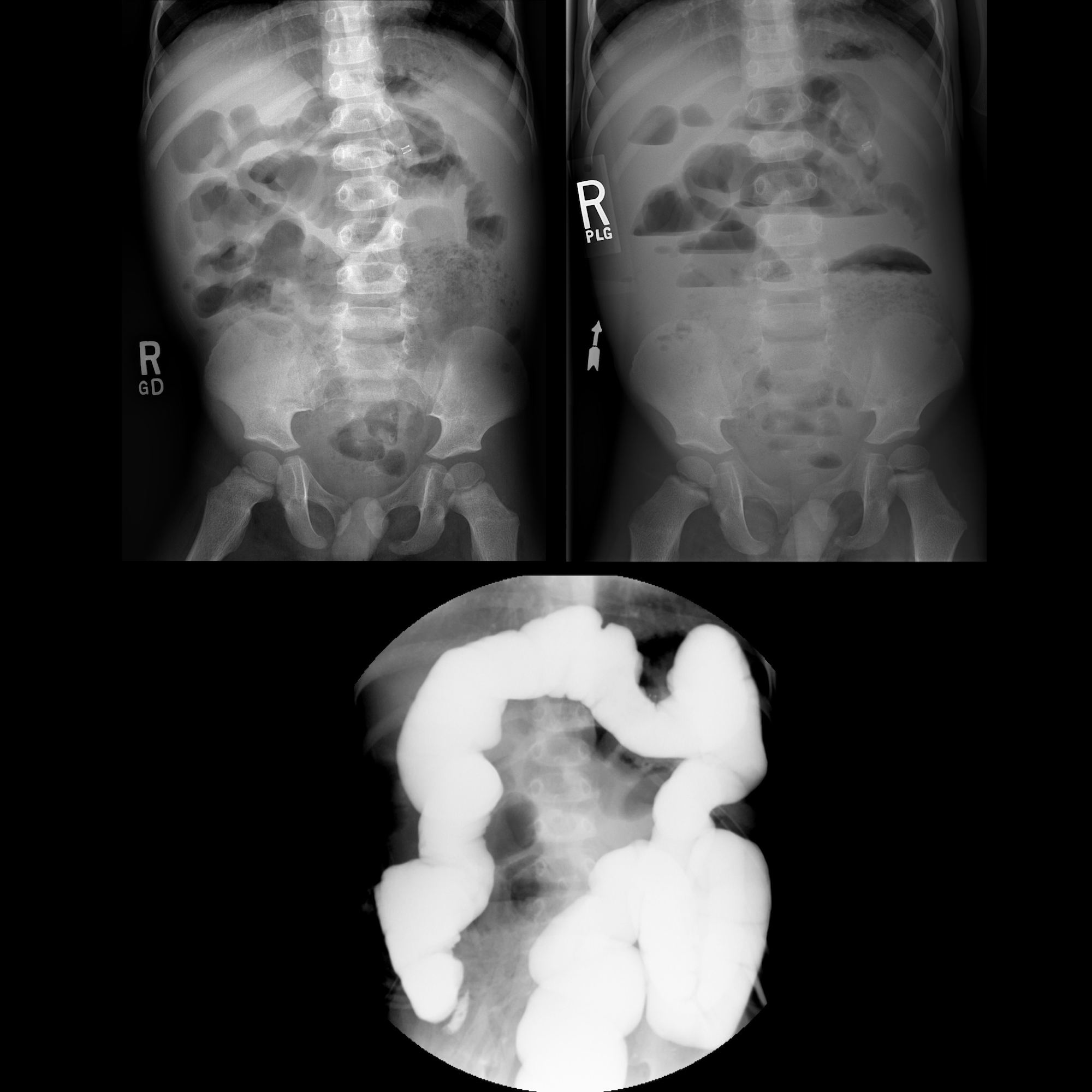 Distal Intestinal Obstruction Syndrome | Pediatric Radiology Reference ...