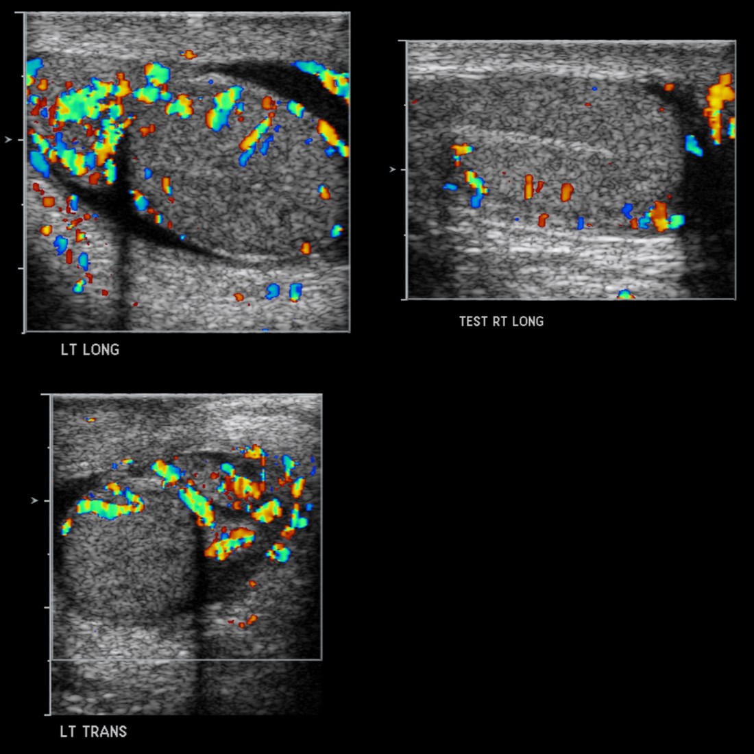 Pediatric Epididimo-Orchitis | Pediatric Radiology Reference Article ...
