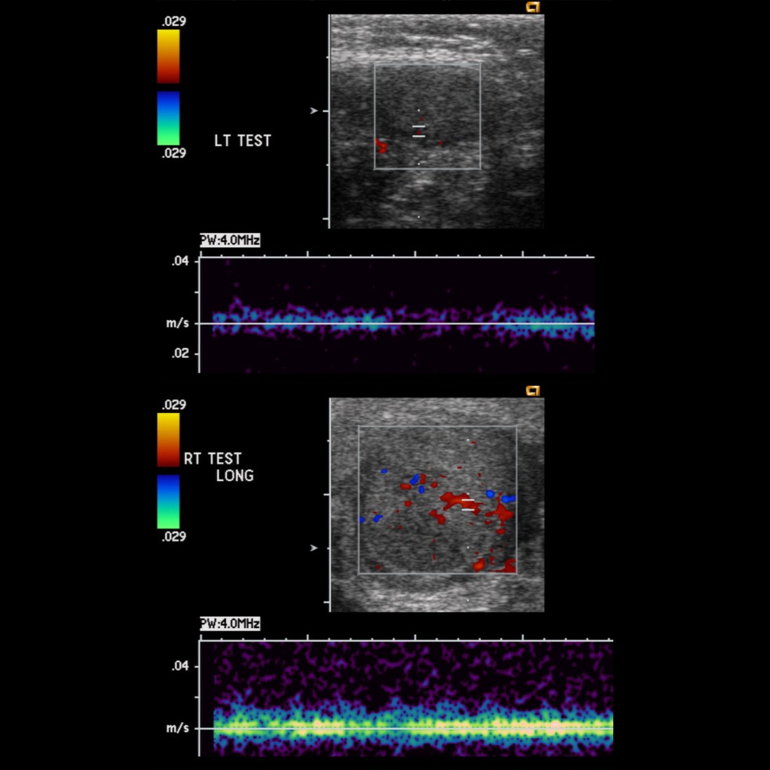 Infant with a hard right testicle | Pediatric Radiology Case ...