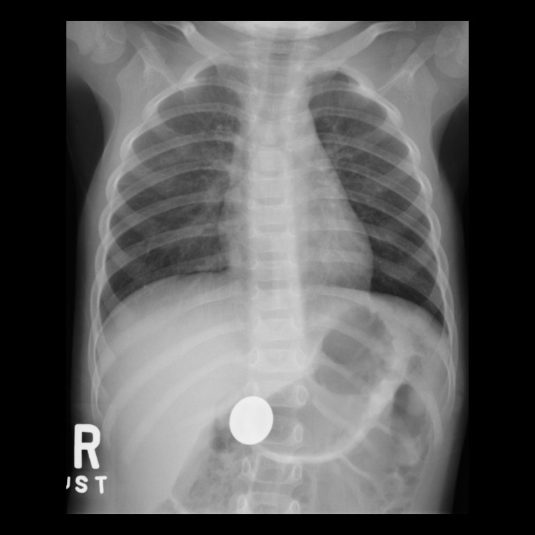 Pediatric Gastrointestinal Foreign Body | Pediatric Radiology Reference ...