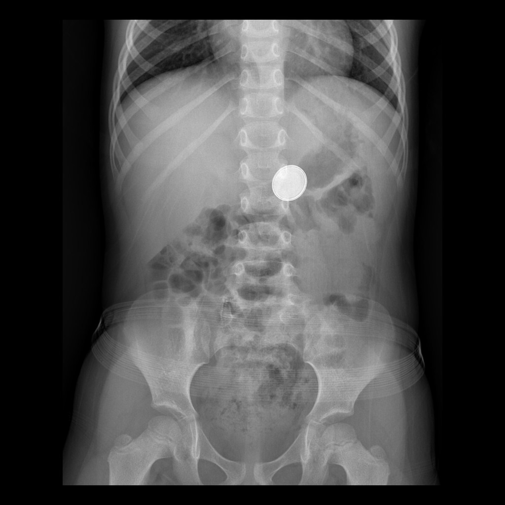 Toddler whose toy was noted to be missing a battery | Pediatric ...