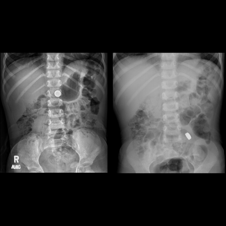Preschooler status post ingestion | Pediatric Radiology Case ...