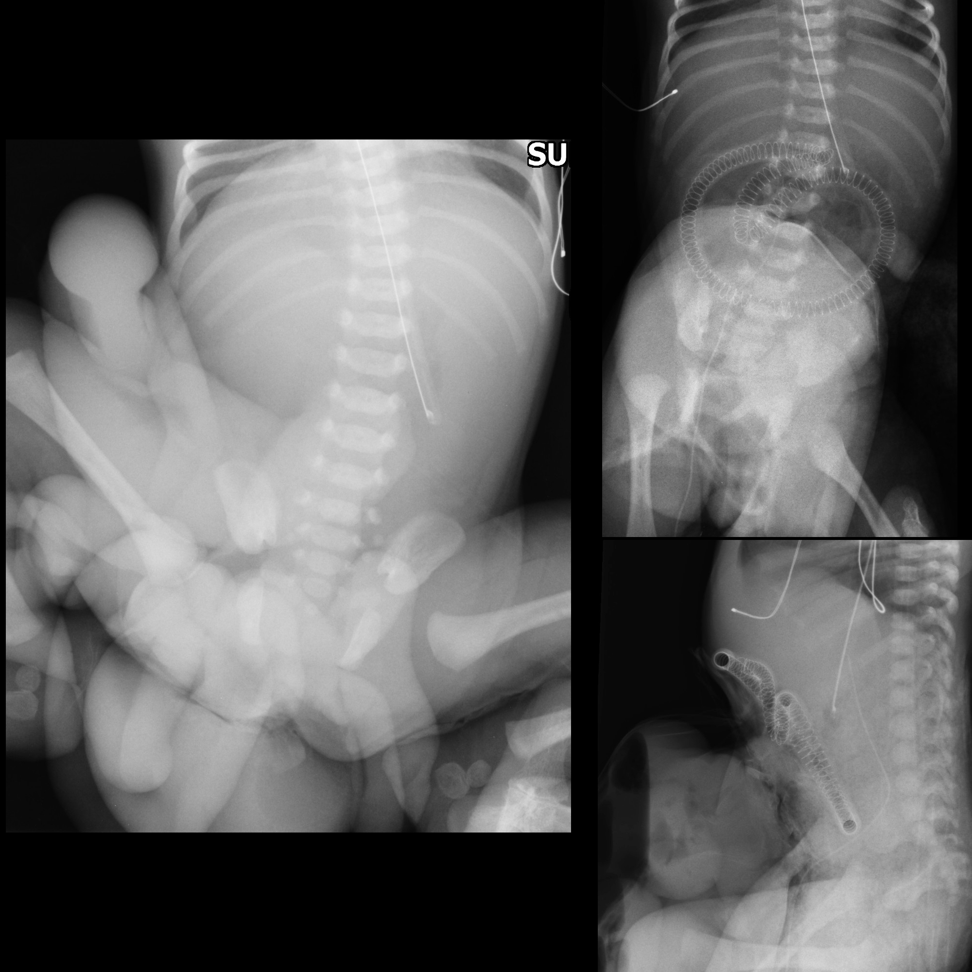 Gastroschisis | Pediatric Radiology Reference Article | Pediatric ...