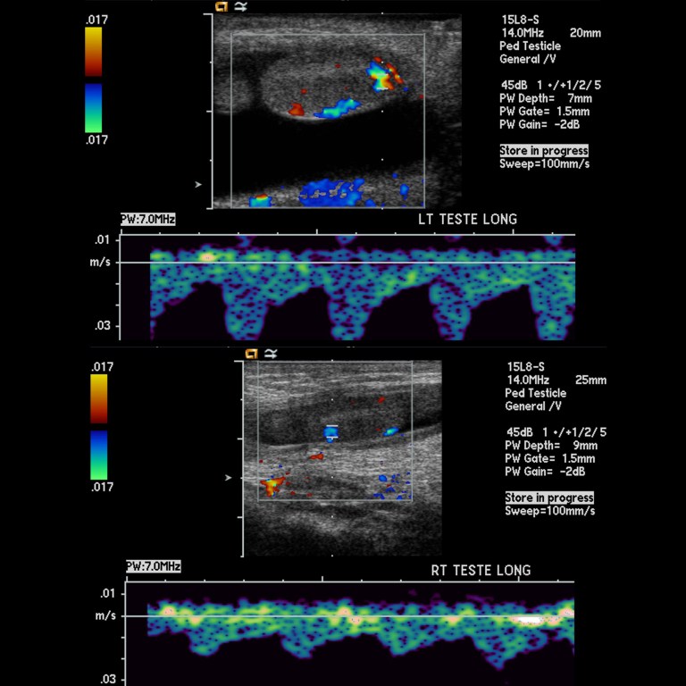 Pediatric Hydrocele | Pediatric Radiology Reference Article | Pediatric ...