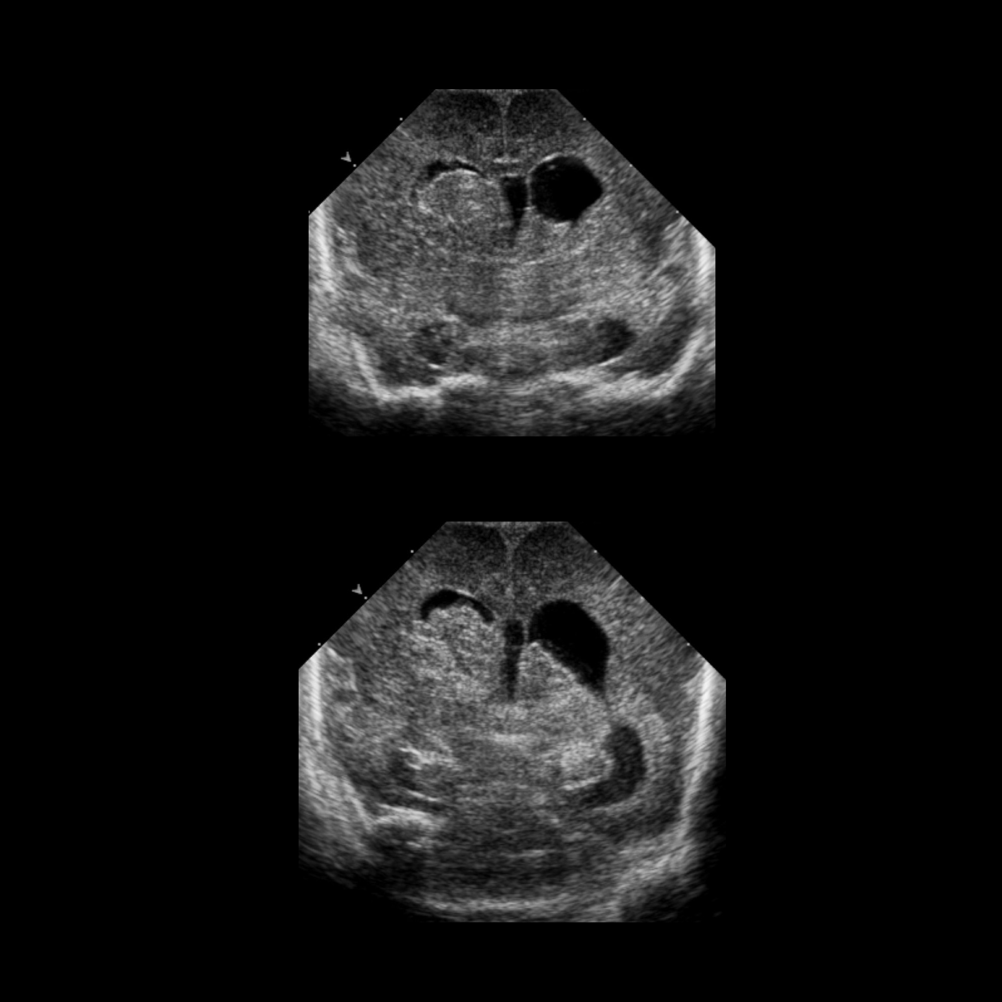 Neonatal Intraventricular Hemorrhage | Pediatric Radiology Reference ...