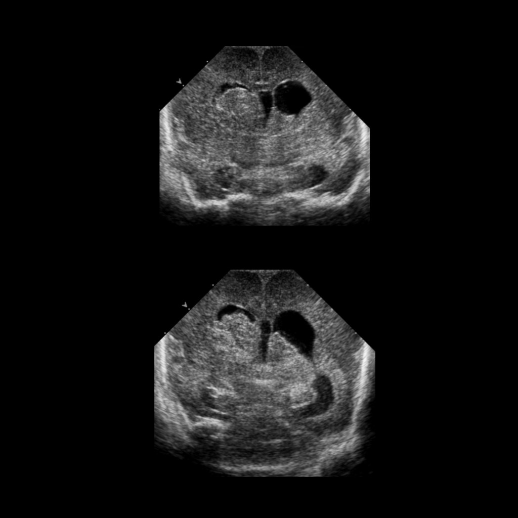Neonatal Intraventricular Hemorrhage | Pediatric Radiology Reference ...