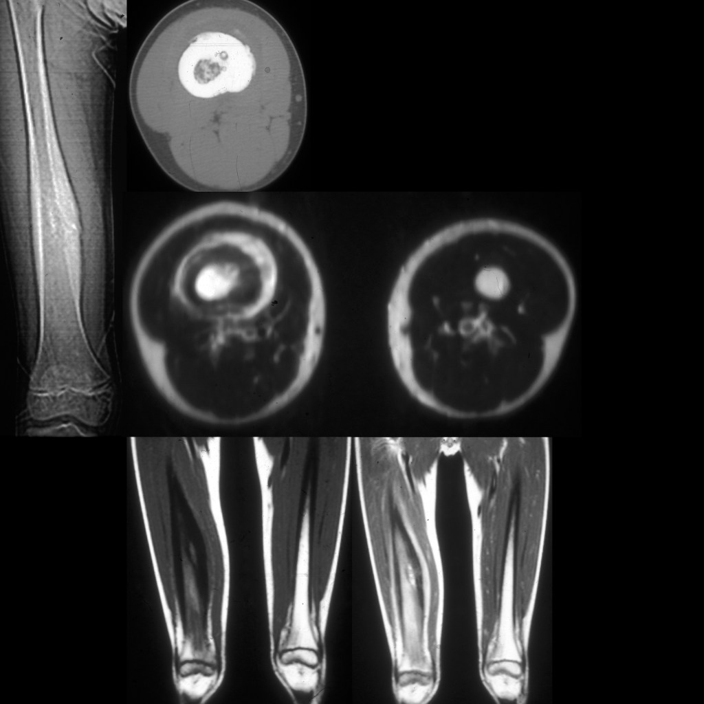 Osteoid Osteoma | Pediatric Radiology Reference Article | Pediatric ...