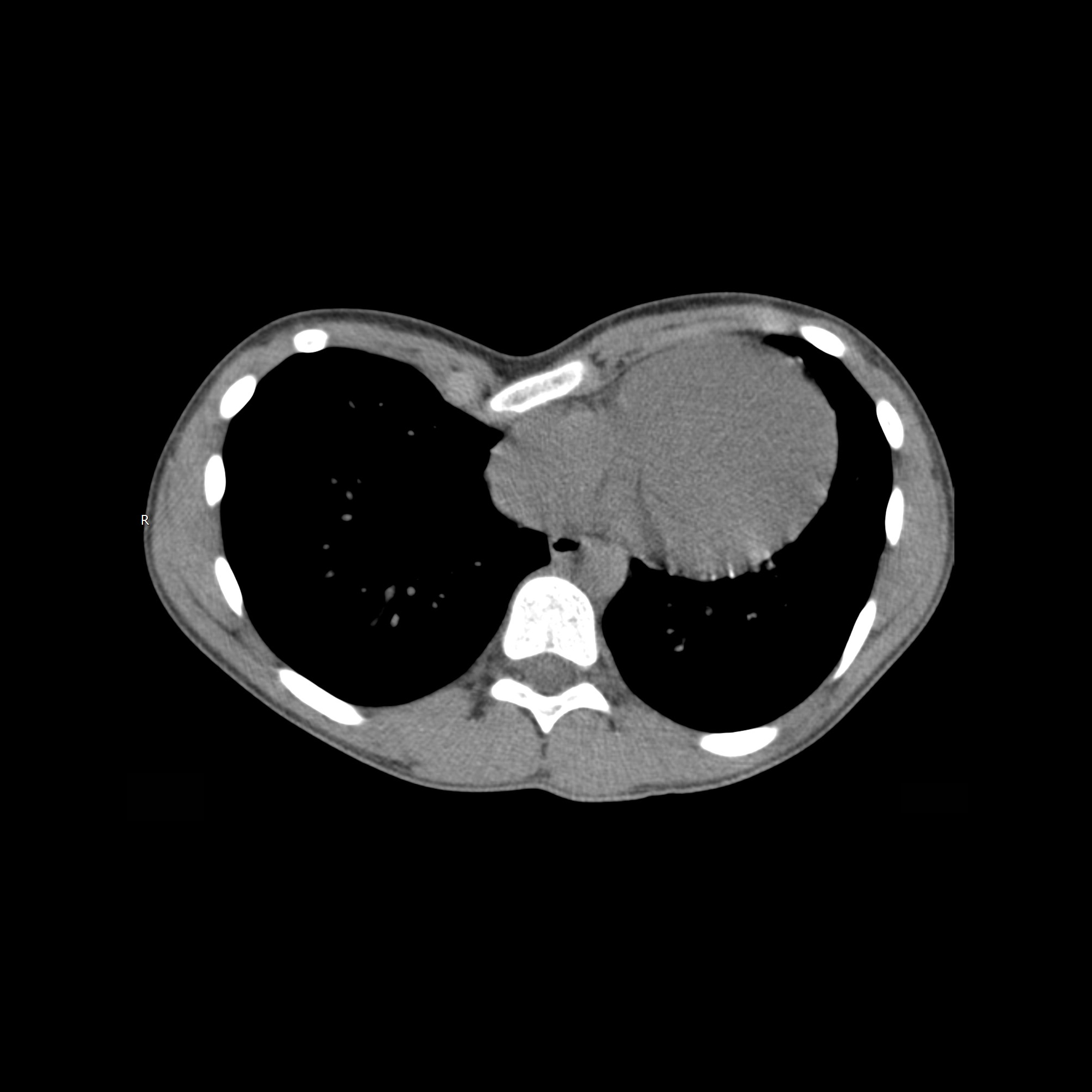 Pectus Excavatum | Pediatric Radiology Reference Article | Pediatric ...