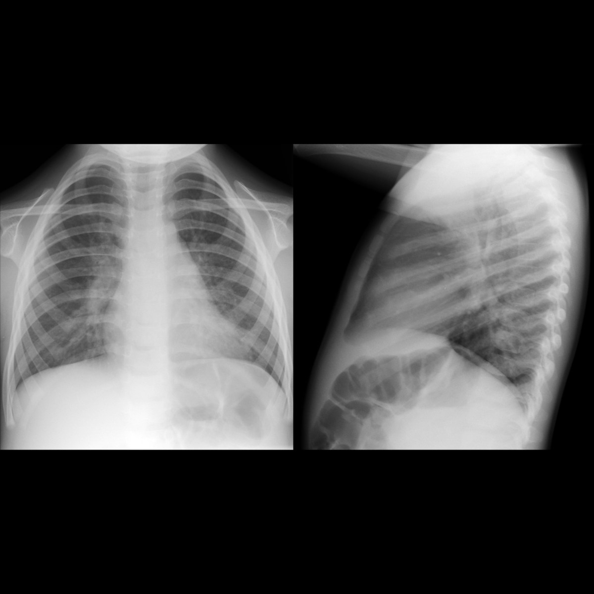 Toddler with fever, cough, and crackles in the lungs | Pediatric ...