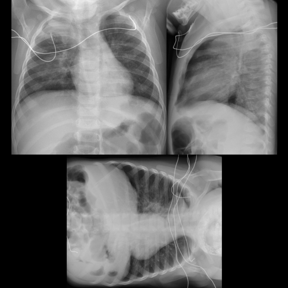 Pediatric Pneumothorax | Pediatric Radiology Reference Article ...
