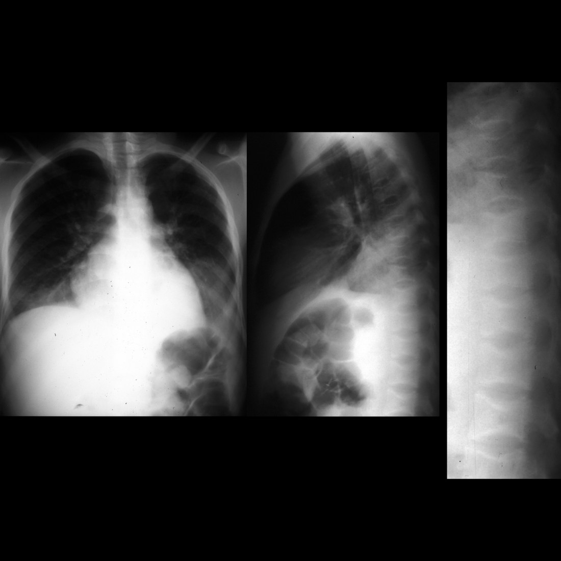 Pediatric Acute Chest Syndrome | Pediatric Radiology Reference Article ...