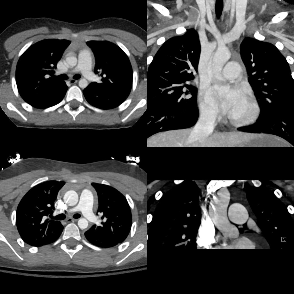 Pediatric Thoracic Aortic Injury | Pediatric Radiology Reference ...