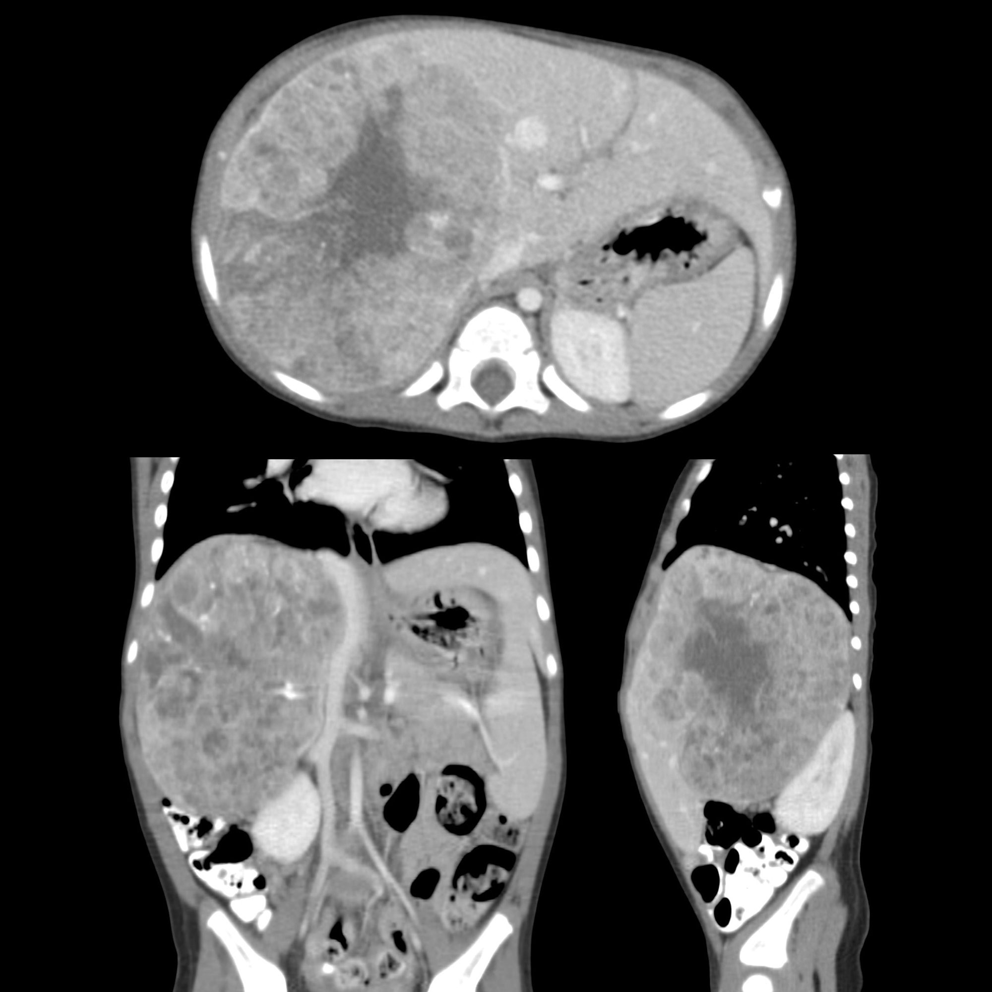 Hepatoblastoma | Pediatric Radiology Reference Article | Pediatric ...