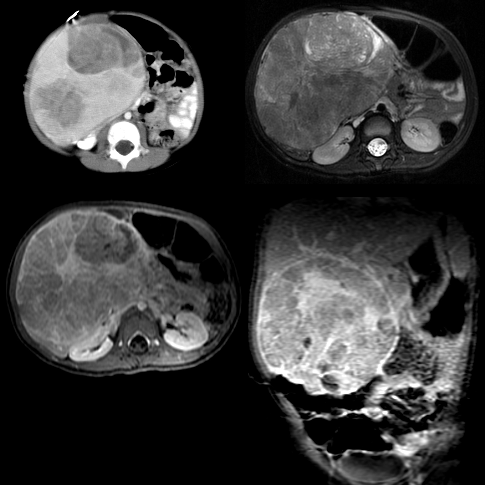 Hepatoblastoma | Pediatric Radiology Reference Article | Pediatric ...