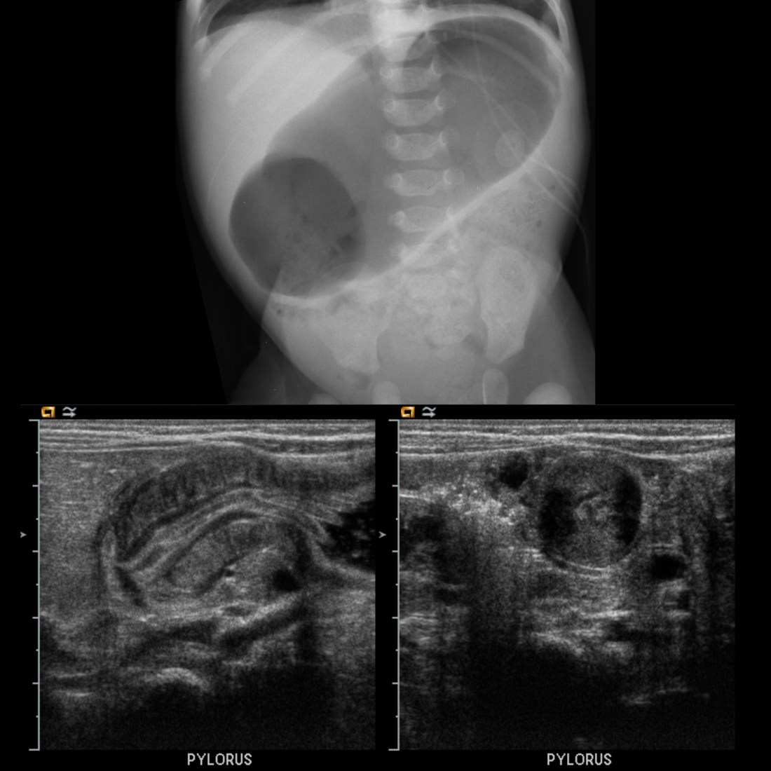 Hypertrophic Pyloric Stenosis | Pediatric Radiology Reference Article ...