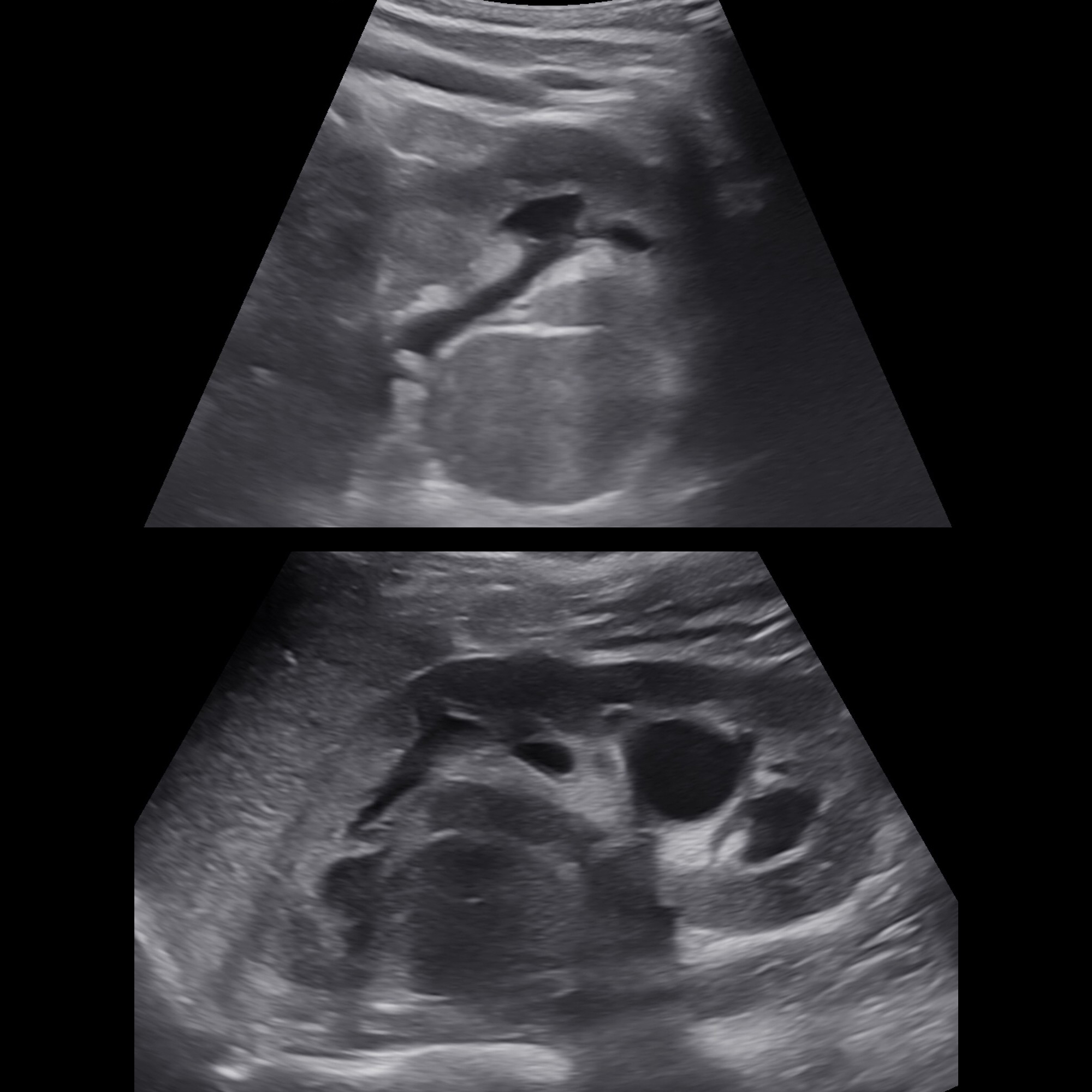 Preschooler with hydronephrosis | Pediatric Radiology Case | Pediatric Imaging | @pedsimaging ...