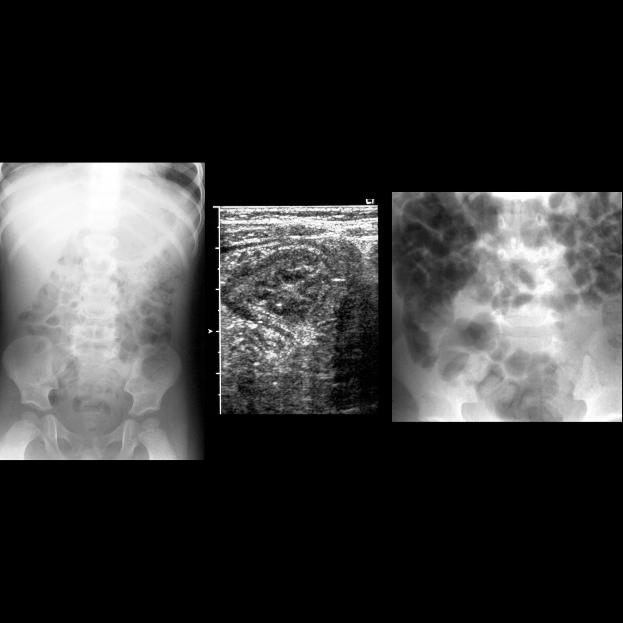 Ileocolic Intussusception | Pediatric Radiology Reference Article ...