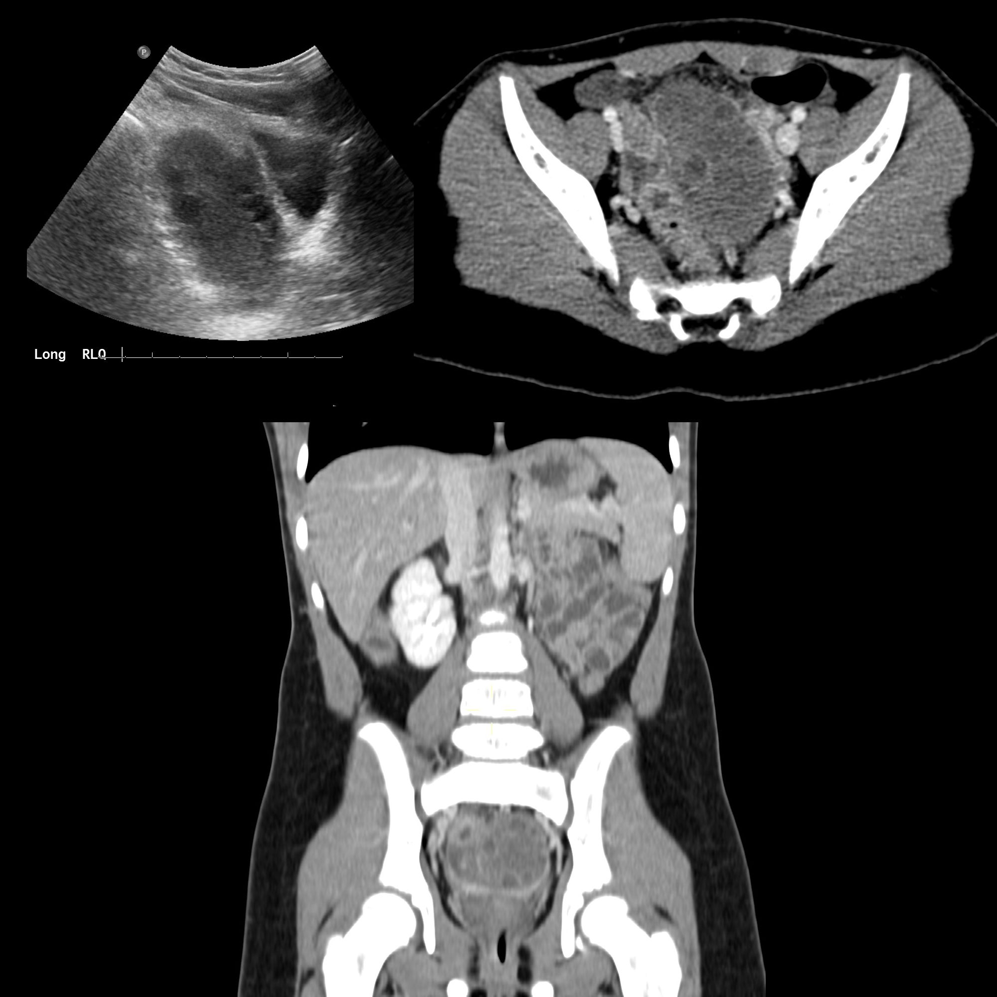 OvarianTorsion01MDDiffuseAbdominalPainUSCT7yo | Pediatric Radiology ...